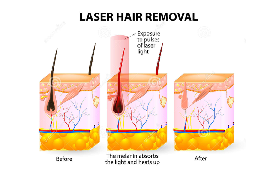 Does diode laser hair removal work? ——Hair growth cycle and its ...