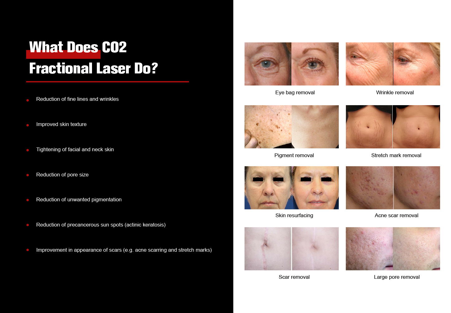 Fractional CO2 Laser Machine|fractional co2 laser|co2 fractional laser ...