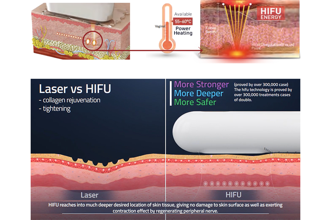 What does HIFU treatment do? - NUBWAY