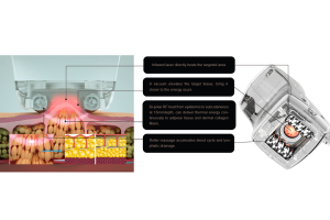 What is a V-Shape slimming machine? - NUBWAY