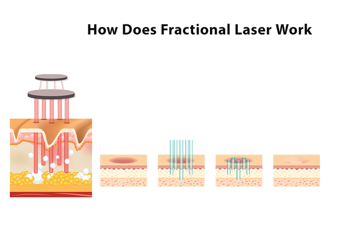 Does CO2 fractional laser really work? - NUBWAY