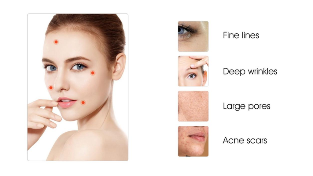 Can I do microneedling at home? - NUBWAY
