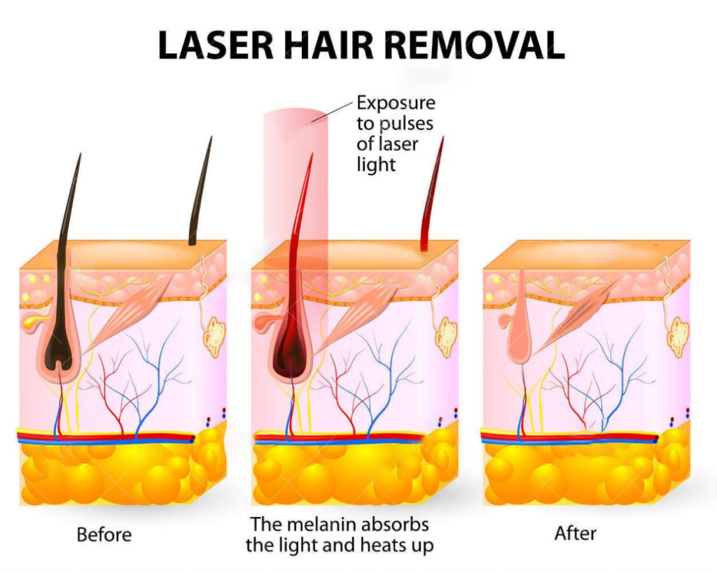 808 Pain-Free Permanent Hair Removal - NUBWAY